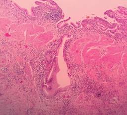 Adenomiomatosis de la vesícula biliar. Aspectos críticos para la ...