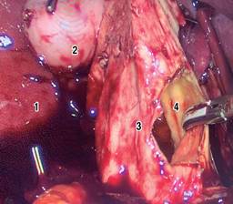 Quiste de colédoco tipo IVA basado en la clasificación de Todani