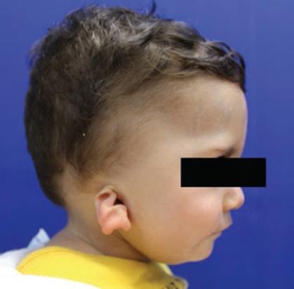 Síndrome de Goldenhar: protocolo de manejo quirúrgico en un centro de ...