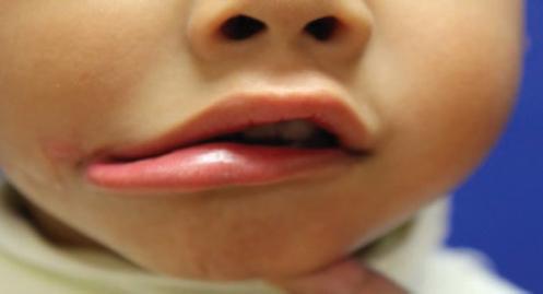 Síndrome de Goldenhar: protocolo de manejo quirúrgico en un centro de ...