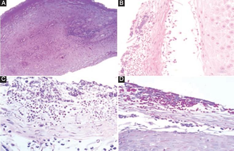 La disfagia de corta evolución y su asociación con la esofagitis ...