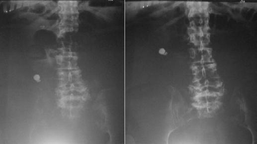 Obstrucción intestinal por cápsula endoscópica en un paciente con ...