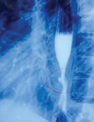 Procedimiento de Collis-Nissen laparoscópico para el tratamiento del ...