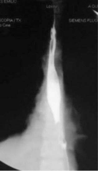 Procedimiento de Collis-Nissen laparoscópico para el tratamiento del ...