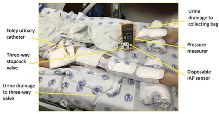 A novel disposable sensor for measure intra-abdominal pressure