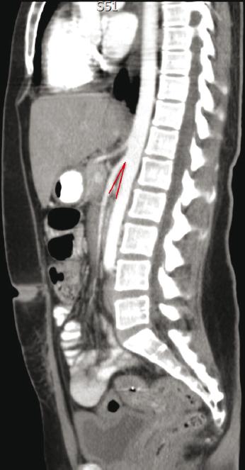 Wilkie’s syndrome as a cause of bowel obstruction in adults: A case report