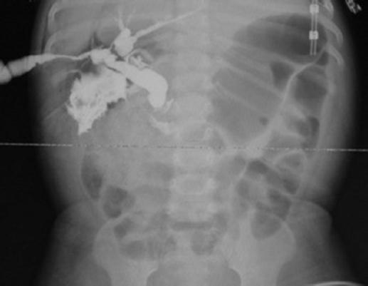 Perforación espontánea de colédoco en un paciente pediátrico ...