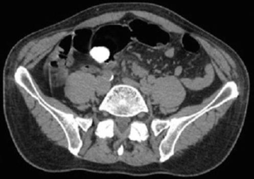 Comparison between surgical techniques in gallstone ileus and outcomes