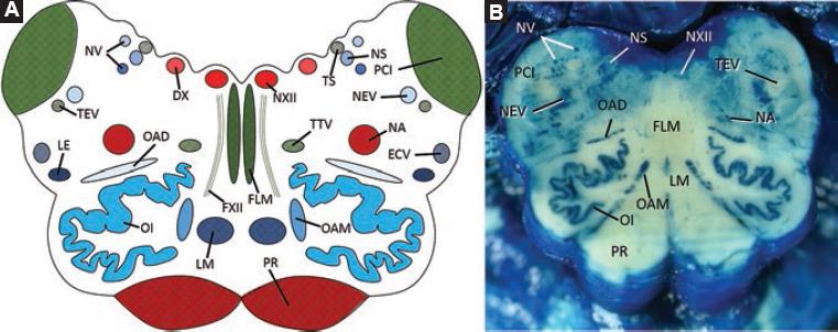 Anatomía Del Síndrome Medular Lateral