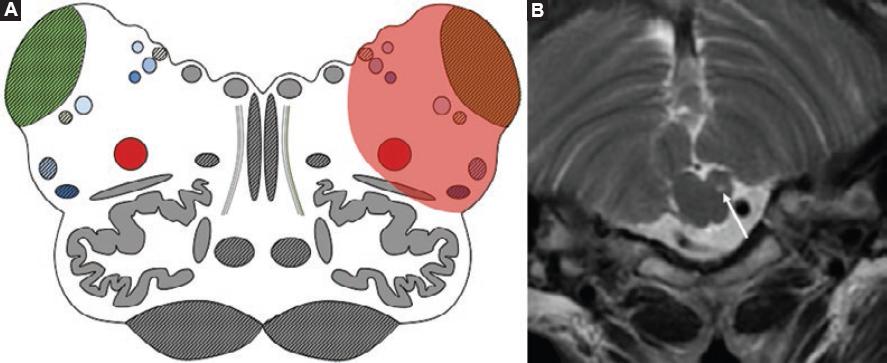 Bases neuroanatómicas del síndrome de Wallenberg