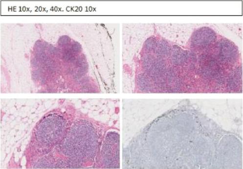 Carcinoma de células de Merkel: características clínicas y ...