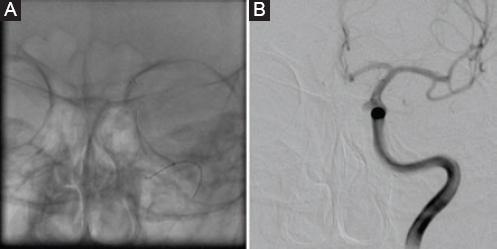 Aneurisma del cavum carotídeo tratado con stent Solitaire™ AB. Reporte ...