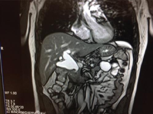 Cirugía pancreatobiliar laparoscópica: experiencia inicial en el ...