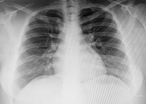 Úlcera marginal perforada tras bypass gástrico. ¿Cuál es el manejo ...