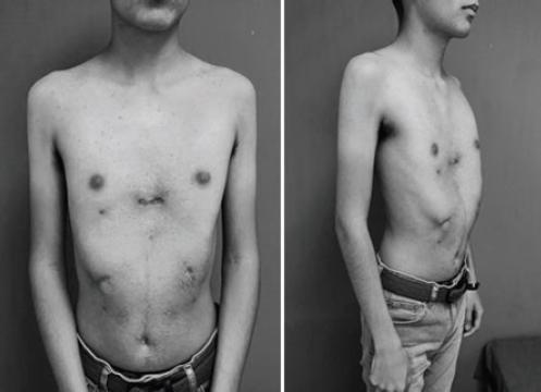 Pectus up: la nueva técnica de tracción para pectus excavatum. Primera ...