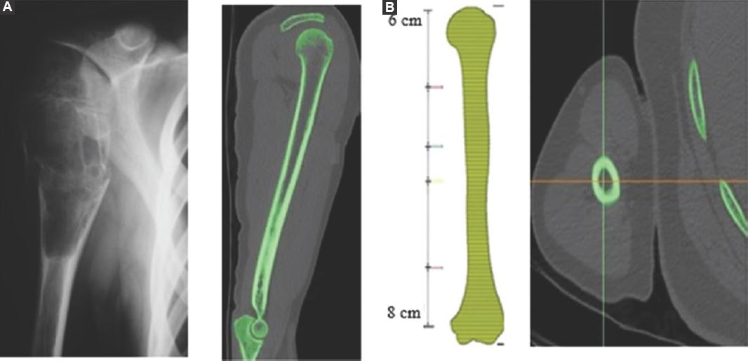 Parametrización de una prótesis tumoral de húmero y el desarrollo de un set
