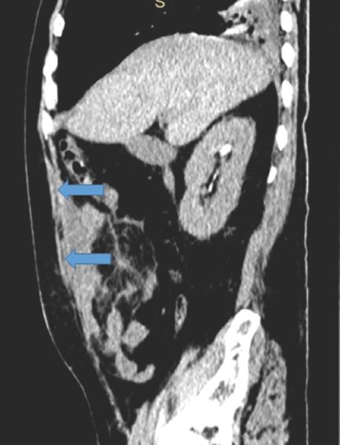 Frozen abdomen complicated with midline heterotopic peritoneal ...