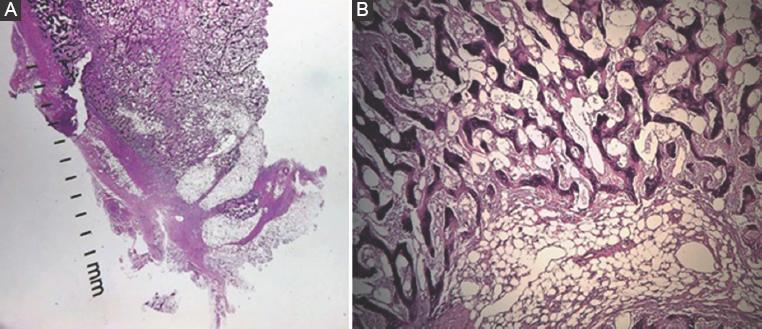 Frozen abdomen complicated with midline heterotopic peritoneal ...