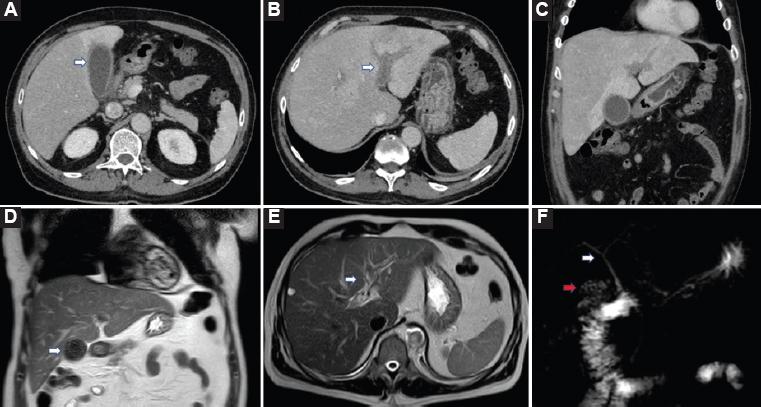 Acute portal vein thrombosis in mild cholecystitis. A consequence of ...