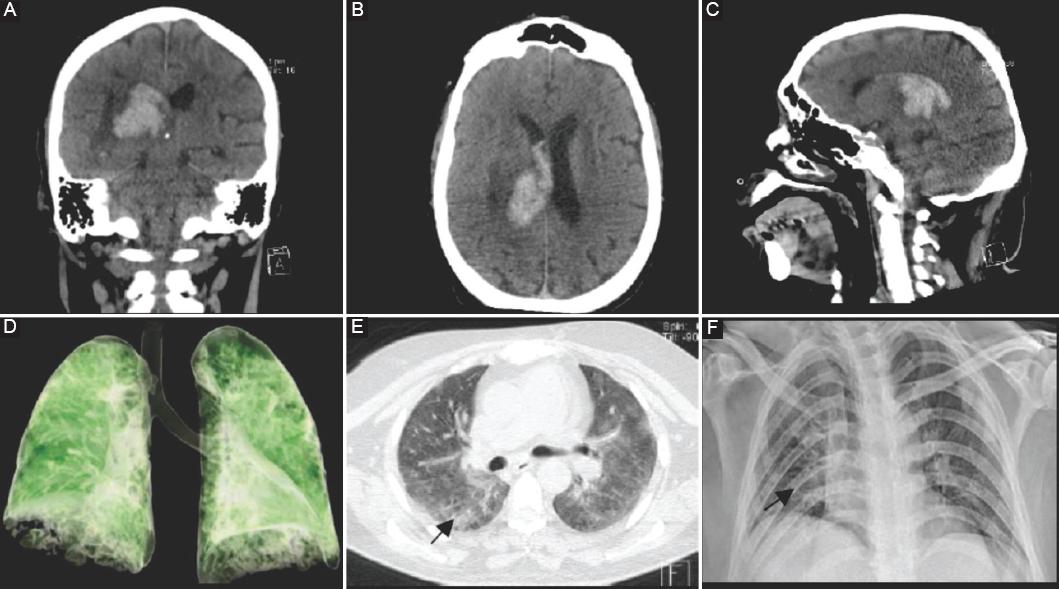 Hemorrhagic stroke associated to COVID-19 infection in Mexico General ...