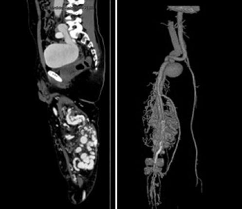 Endovascular management of a complex high-flow lower limb arteriovenous ...