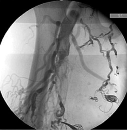 Endovascular management of a complex high-flow lower limb arteriovenous ...
