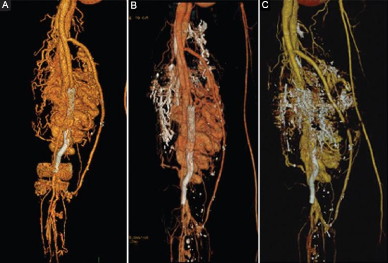 Endovascular management of a complex high-flow lower limb arteriovenous ...