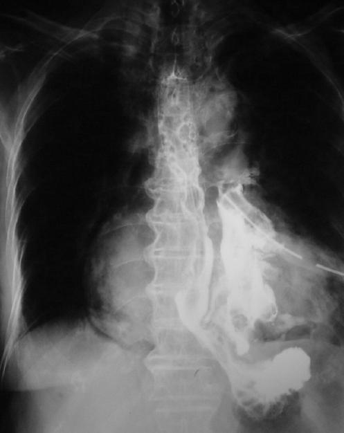 Boerhaave Syndrome