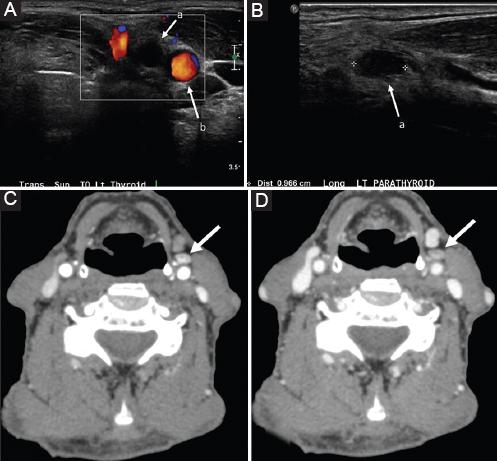 Parathyroid Adenoma Hypoechoic