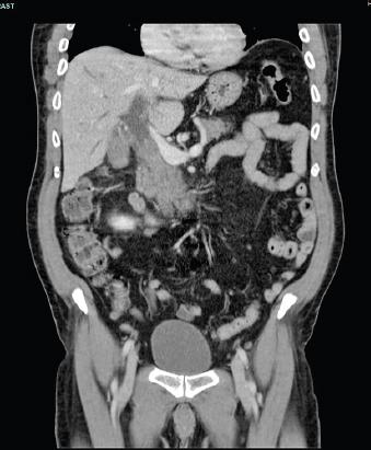 Hemobilia y hemocolecisto agudo como forma de presentación inusual del ...