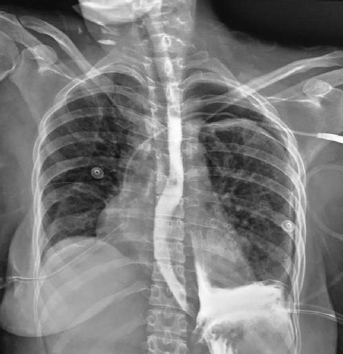 Síndrome de Boerhaave con doble perforación esofágica. A propósito de ...