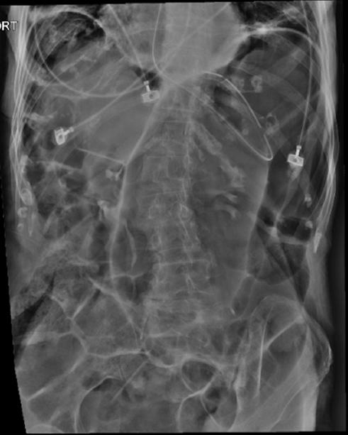 Cecal Volvulus Coffee Bean Sign