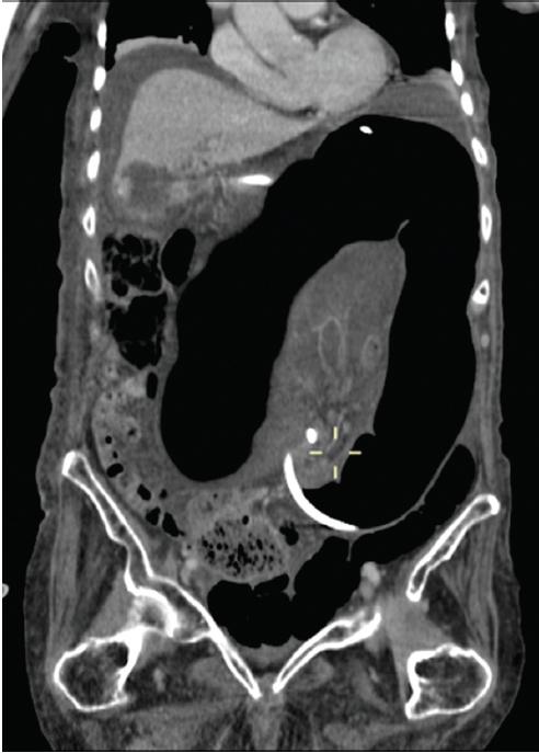 Sigmoid Colon Volvulus