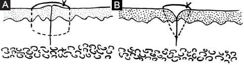 Main pitfalls of skin surgical suturing – review for junior surgeons ...