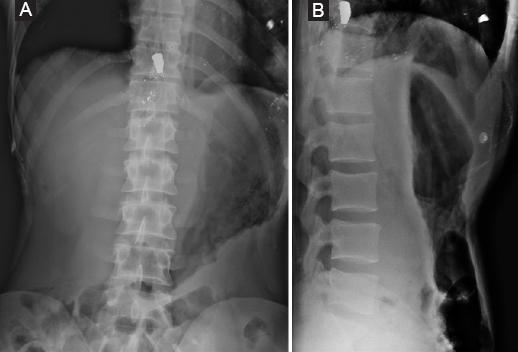 Two-year prevalence of spinal gunshot injuries in Mexico: A single ...