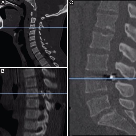 Two-year prevalence of spinal gunshot injuries in Mexico: A single ...