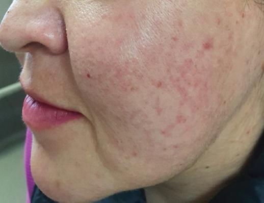 Dermatosis más frecuentes en pacientes con trasplante renal