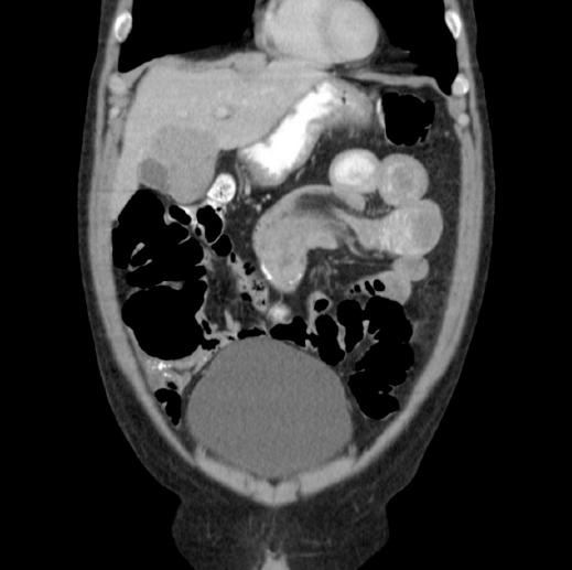 Intususcepción intestinal por linfoma de Burkitt en un paciente adulto ...