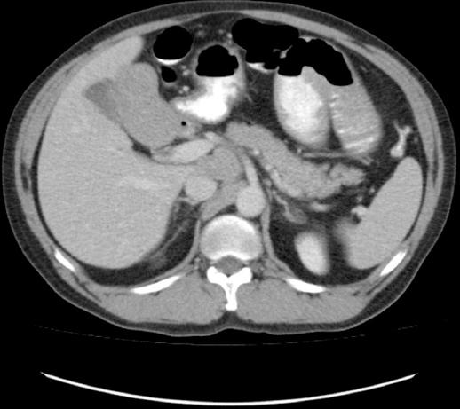 Intususcepción intestinal por linfoma de Burkitt en un paciente adulto ...