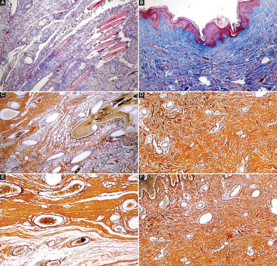 The role of collagen type I/III ratio in the etiology of sacrococcygeal ...