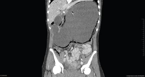 Acute massive gastric distention with emphysematous gastritis: a case ...