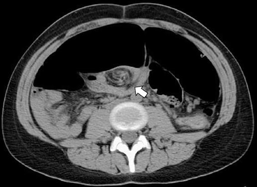 Reporte de caso: vólvulo de sigmoides en un adulto joven, una ...