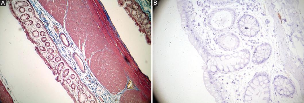 Reporte de caso: vólvulo de sigmoides en un adulto joven, una ...