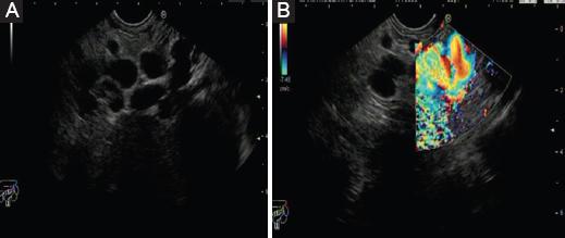 Embolización guiada por ultrasonido endoscópico con cianoacrilato solo ...