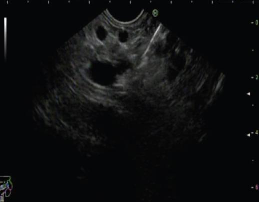 Embolización guiada por ultrasonido endoscópico con cianoacrilato solo ...