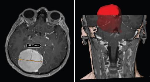 Application of neuronavigation system in intracranial meningioma ...
