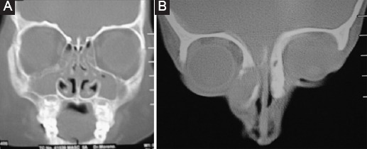 Hallazgos nasosinusales por tomografía computada en dacriocistitis ...