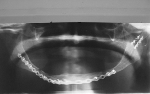 Tratamiento de fracturas en mandíbula atrófica