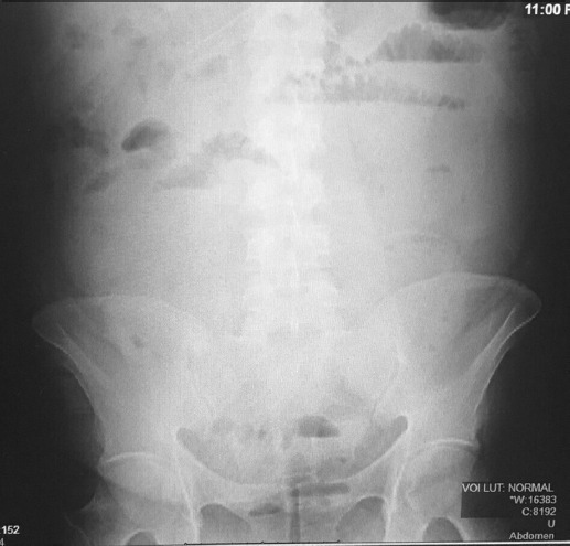 Íleo biliar recurrente, una causa infrecuente de oclusión intestinal ...