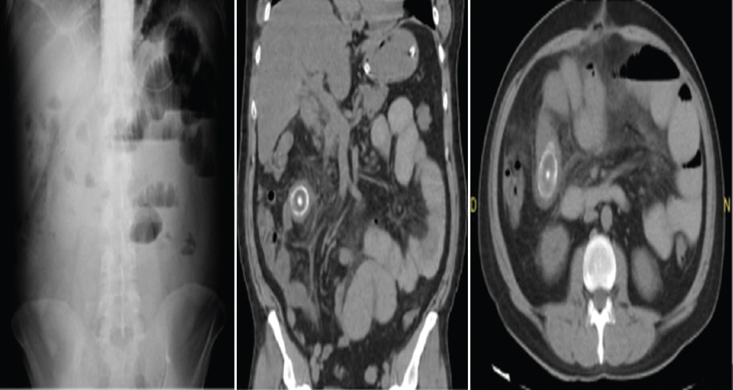 Íleo biliar recurrente, una causa infrecuente de oclusión intestinal ...